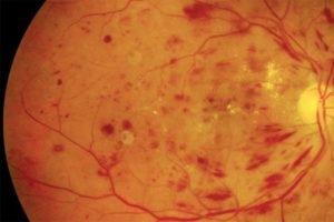 Fotocoagulación Laser » Enfoque Visión Oftalmólogo Saltillo